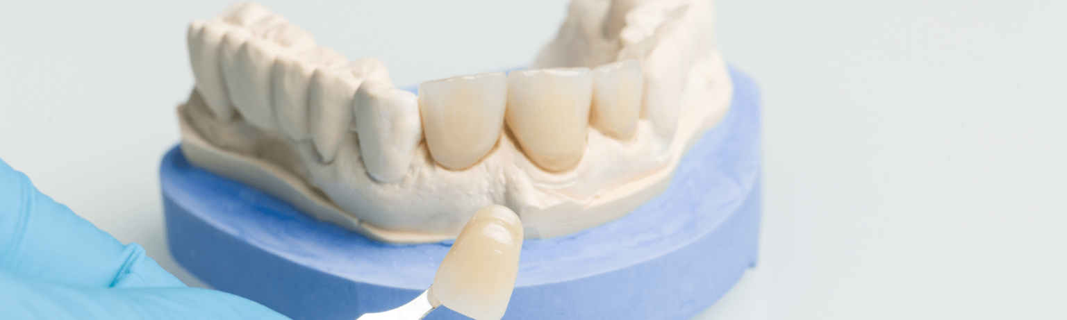 Couronne dentaire : tout ce que vous devez savoir - New Dentaire